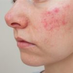 Redness on Face: Causes and Ways to Reduce It | Cascade Eye & Skin Centers