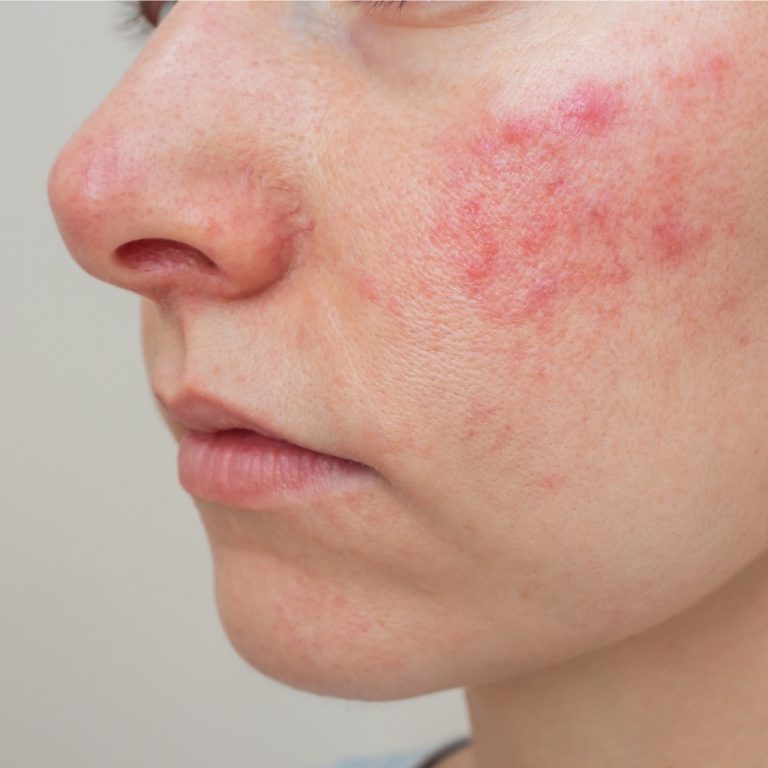 Redness on Face: Causes and Ways to Reduce It | Cascade Eye & Skin Centers
