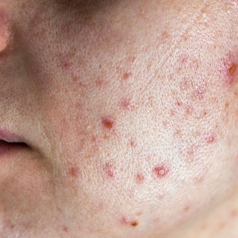 Redness on Face: Causes and Ways to Reduce It | Cascade Eye & Skin Centers