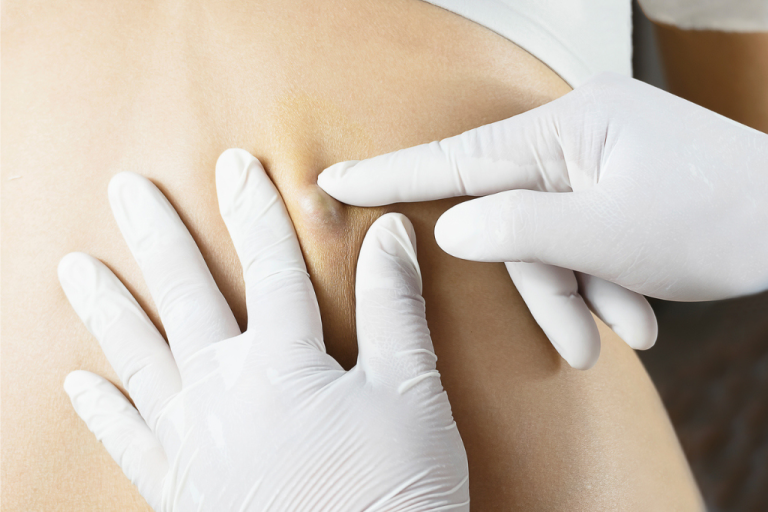 What Is a Cyst? Causes, Types, and When to See a Doctor | Cascade Eye ...